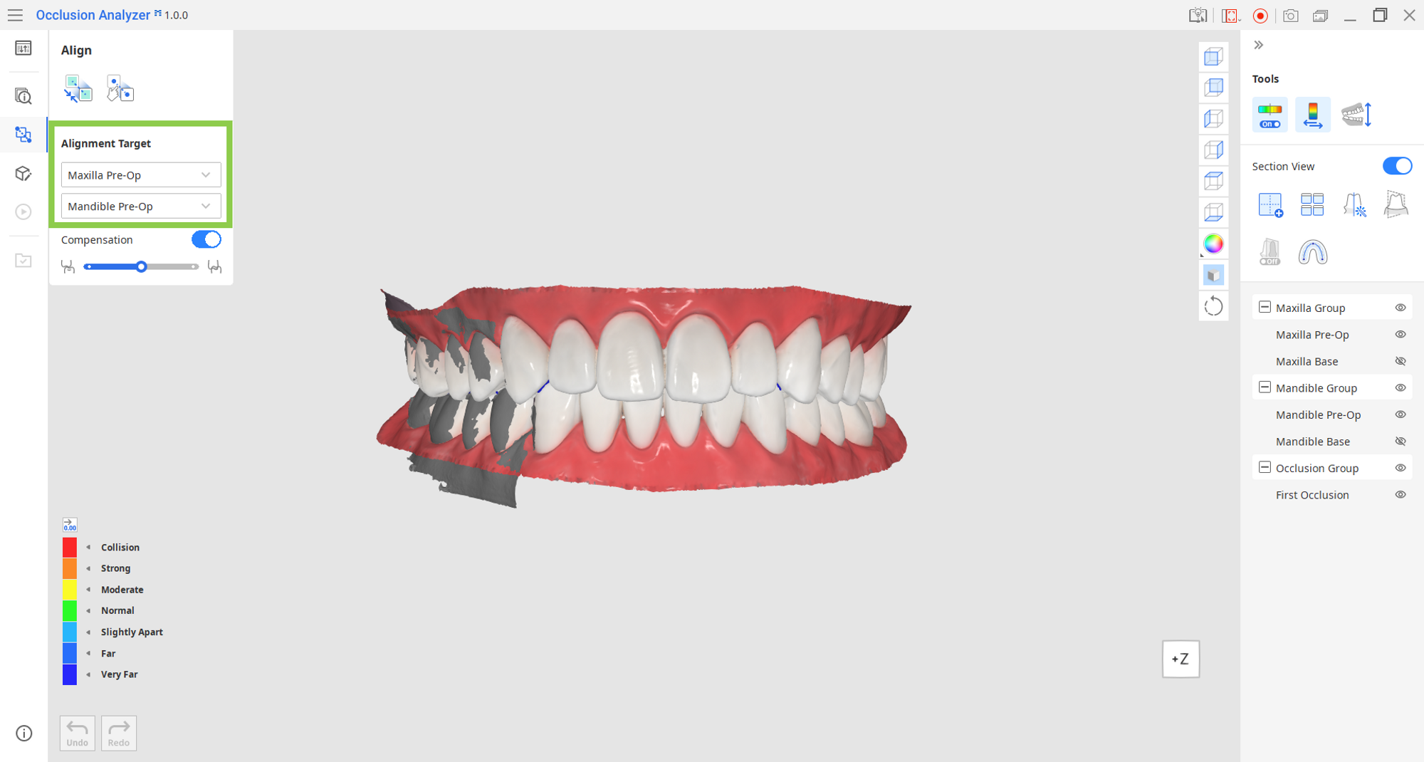 📖 [Occlusion Analyzer] Mode d'alignement – Centre d'aide Medit