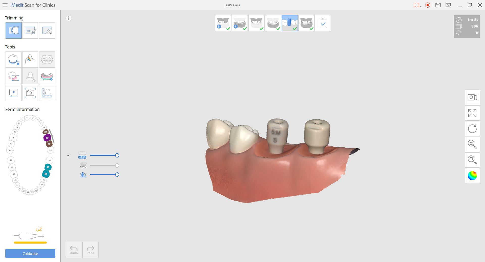 Scanbody scan – Medit Help Center