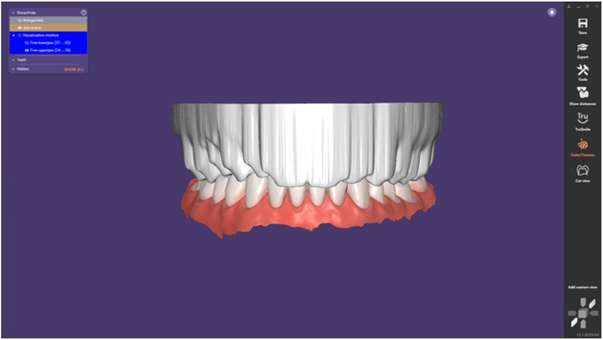 🔍 Use of Dynamic Occlusion Data in exocad – Medit Help Center