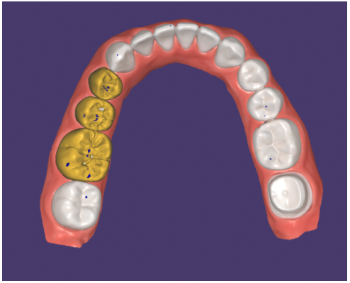 🔍 Use of Dynamic Occlusion Data in exocad – Medit Help Center