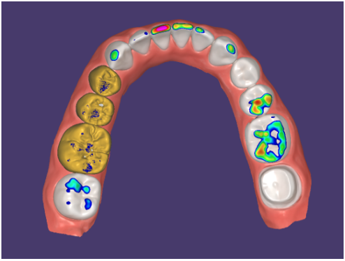 🔍 Use of Dynamic Occlusion Data in exocad – Medit Help Center