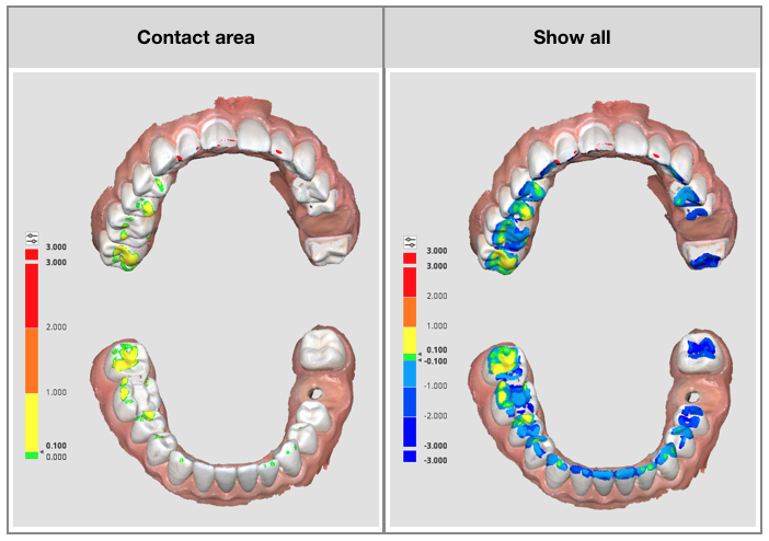 🔍 Occlusion Analysis – Medit Help Center