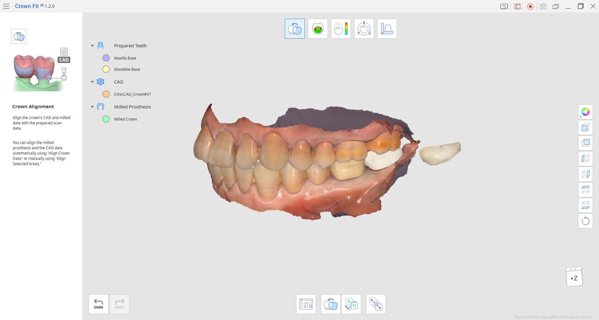 📖 Workflow > Crown Alignment – Medit Help Center