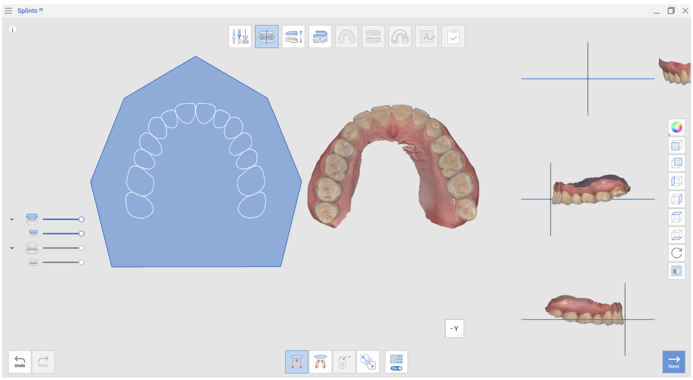 📖 [Splints] Mode > Alignement – Centre d'aide Medit