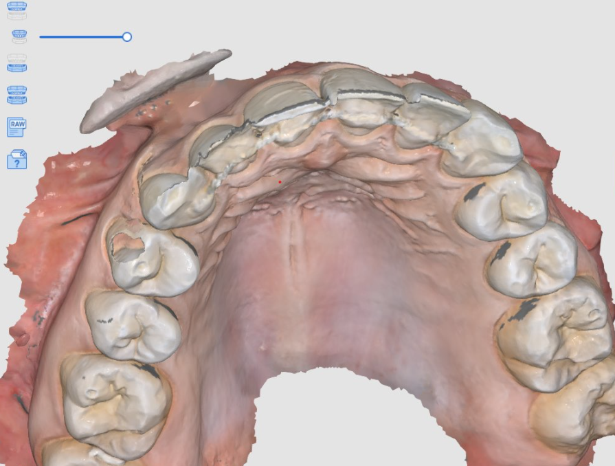 Double-layer scan data – Medit Help Center
